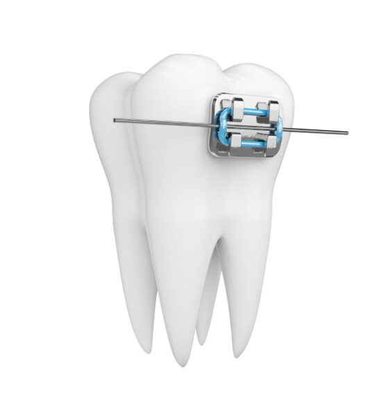 Brackets y Ortodoncia | Ortounión