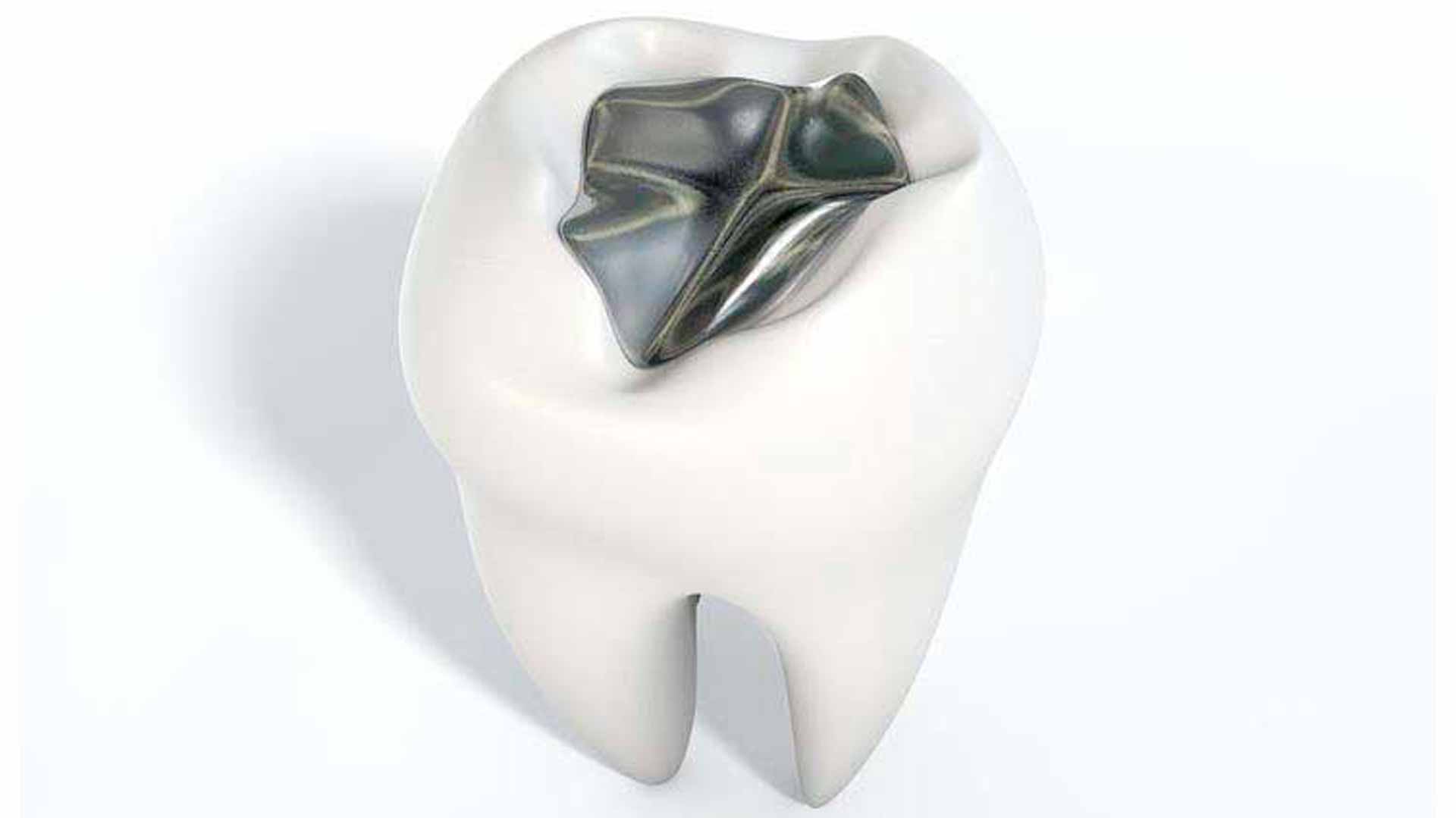 ¿Se pueden cambiar las Amalgamas por Resinas? ¿Calzas dentales negras por blancas? | Ortounión