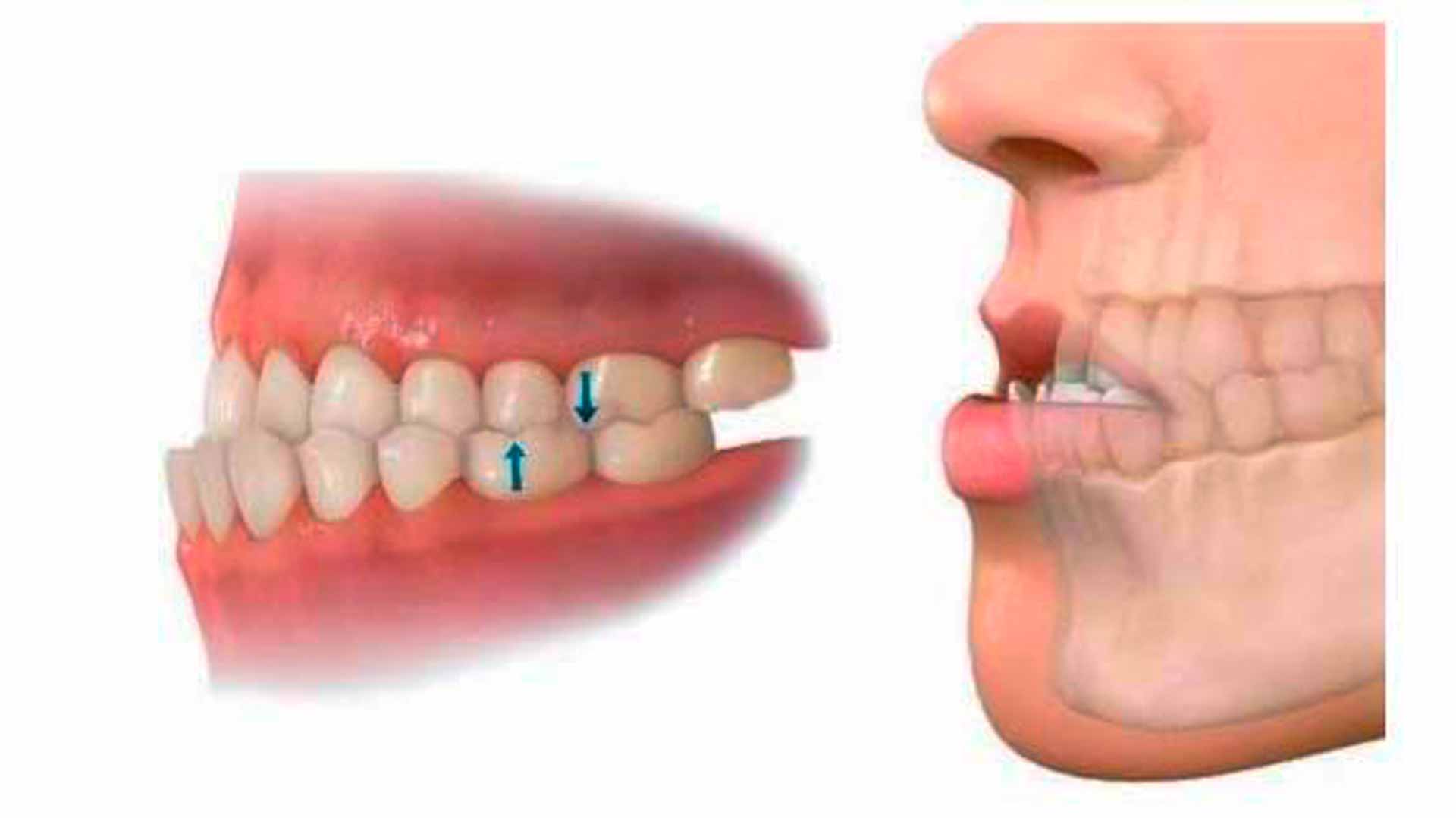 Tipos de Mordida: ¿Cuál tienes y por qué es importante saberlo? | Ortounión
