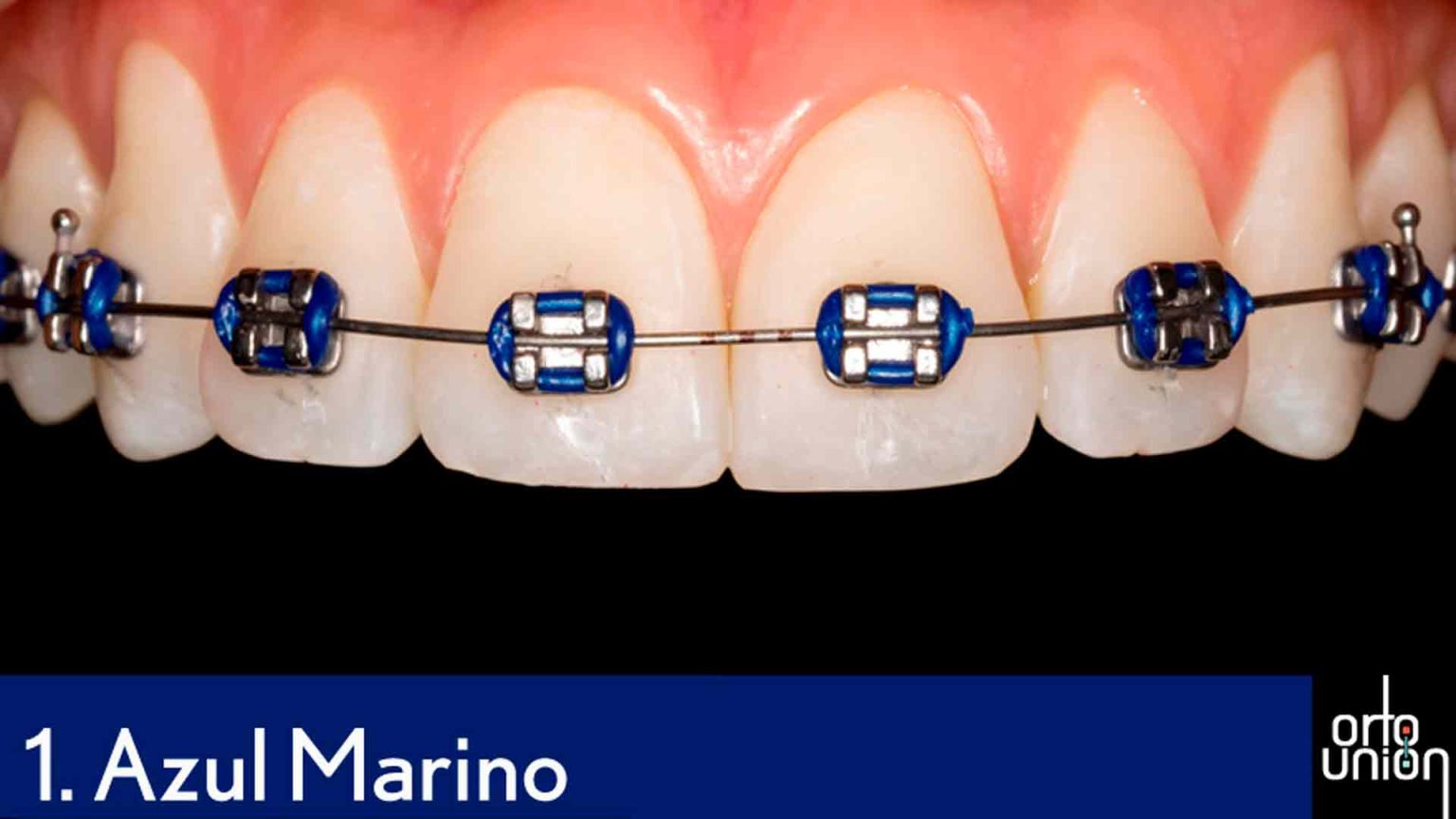 ¿Qué Colores de Cauchos para Tus Brackets Quieres Hoy? | Ortounión