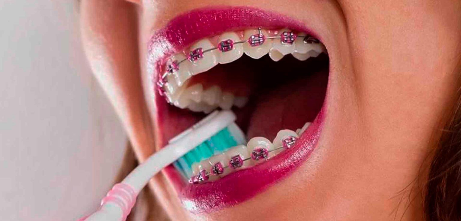 ¿Qué Colores de Cauchos para Tus Brackets Quieres Hoy? | Ortounión