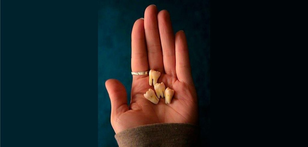 ¿Las cordales tuercen los dientes? | Ortounión