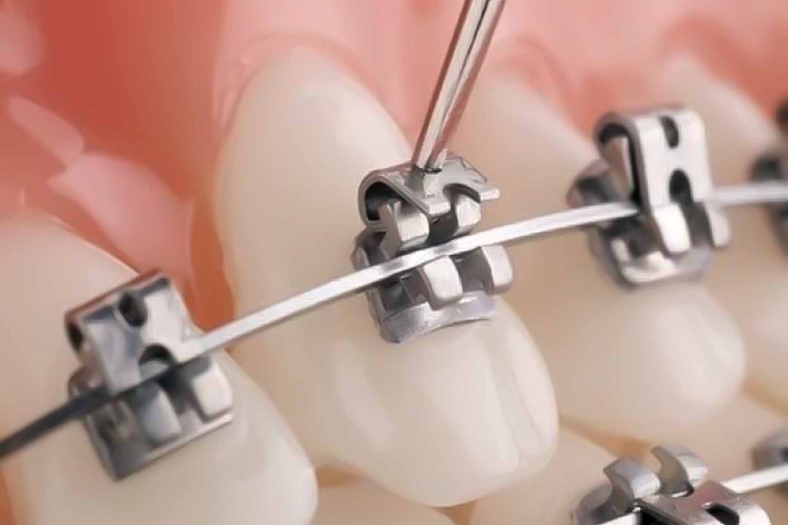 Brackets de Autoligado: Qué son, Beneficios y Cuándo Elegirlos | Ortounión