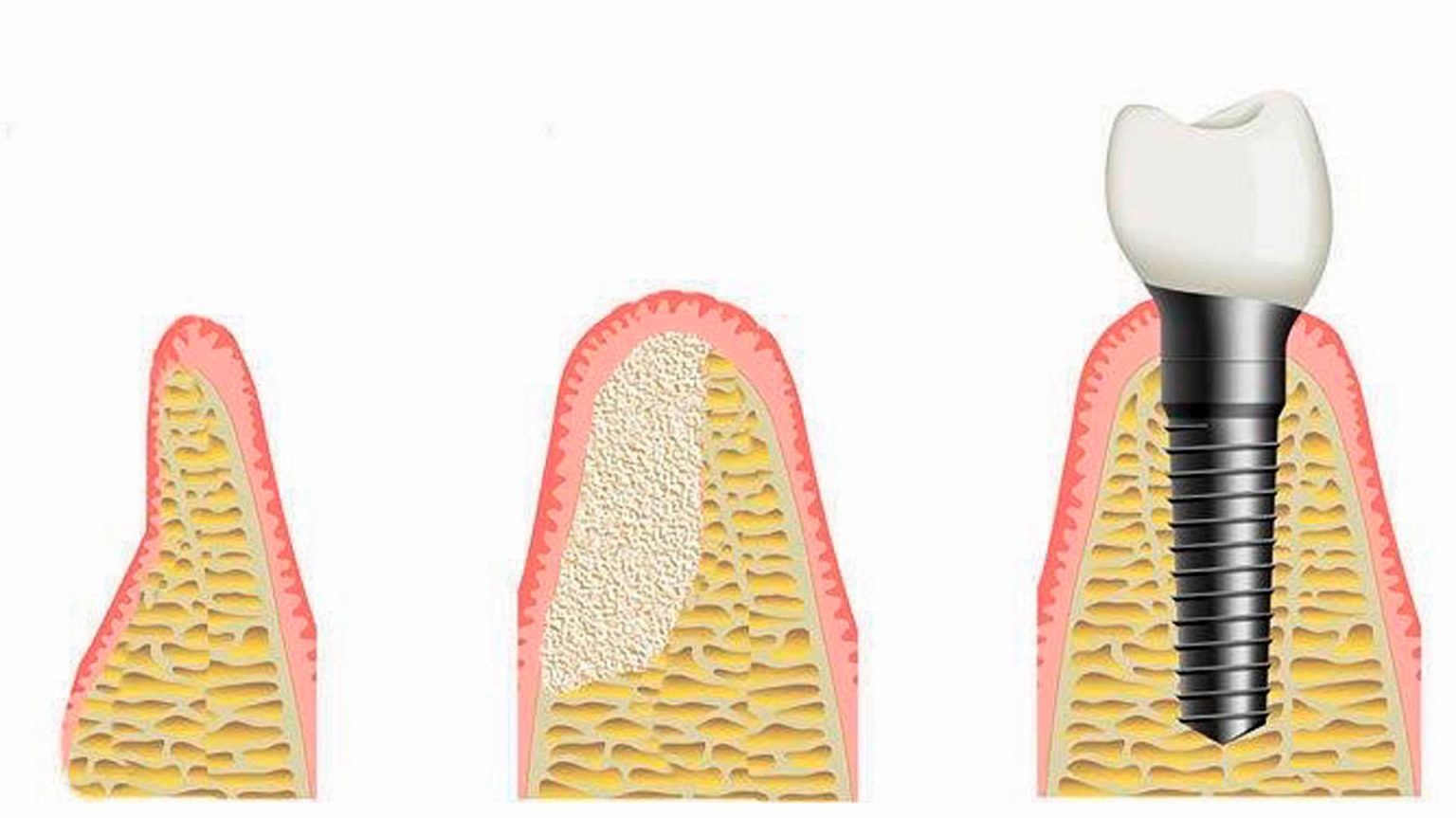¿Qué es un Injerto Óseo Dental y para qué sirve? | Ortounión